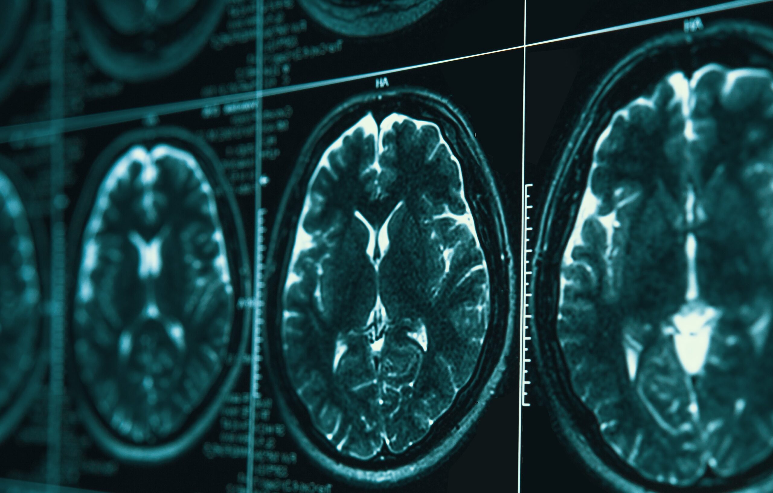 ARIA Imaging: Challenges and Translation to Clinical Practice - ACTC